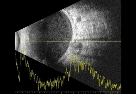 Excited To Share Our Latest Publication “endophthalmitis Following Inadvertent Intravitreal