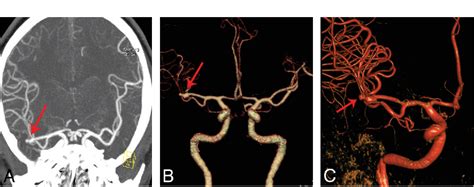 Figure 2 From Of Intracranial Aneurysms Low Contrast Material Volume