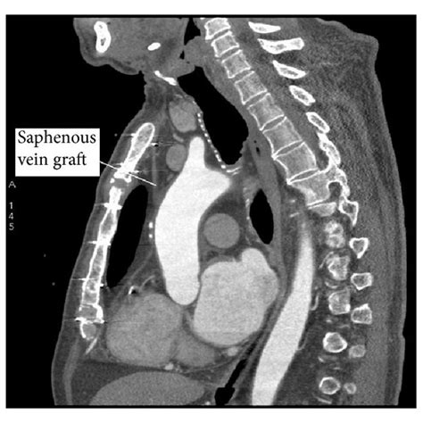 Iabp Removal And Ligation Of The Graft A The Upper Sternotomy Download Scientific Diagram