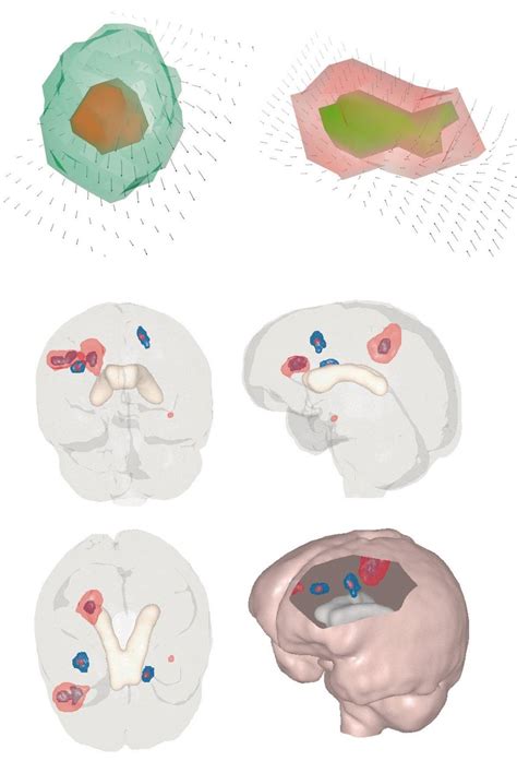 3d Views Of The Segmentation Of Evolving Lesions Between Two Time