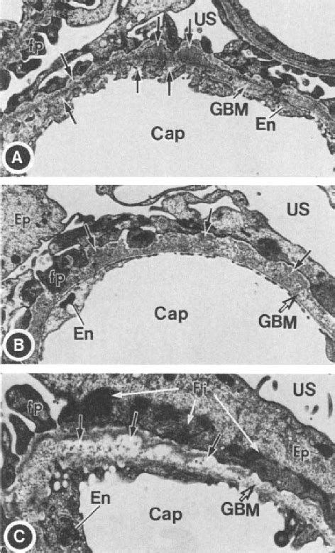 Electron Micrographs Of Portion Of Gloinerular Capillaries Cap