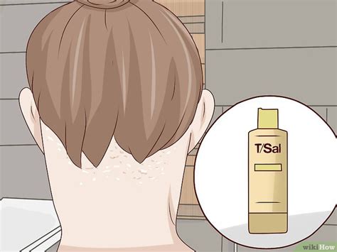 4 Formas De Deshacerte De La Caspa En Casa WikiHow