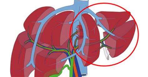 내게 맞는 간 찾기 어려울 때 작은 간 이식해 몸속에서 키운다