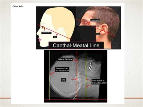Brain Ct Scan Pptx