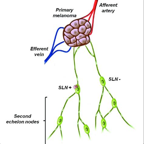 A Figo Stage Ii Vulvar Cancer With Hot And Cold Slns 1 Cm On Download Scientific Diagram