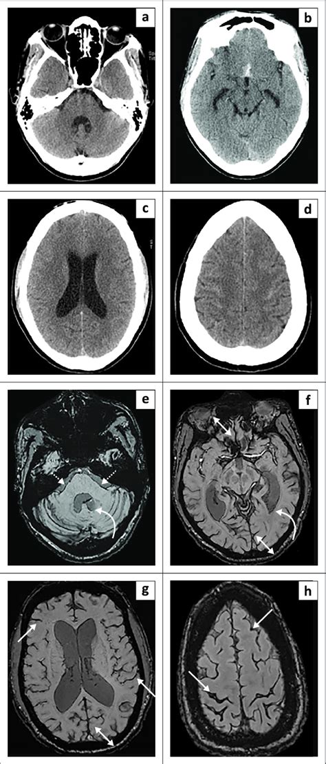The Nect At Presentation A D And Swi At 3 Months E H In A Patient