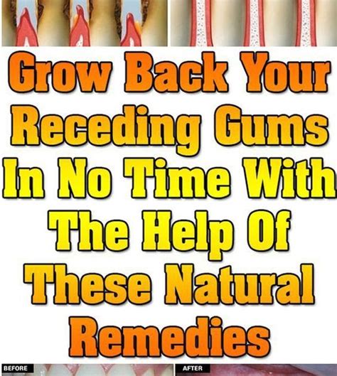 The Situation Of Receding Gums Happens When The Tissue Of The Gum Around The