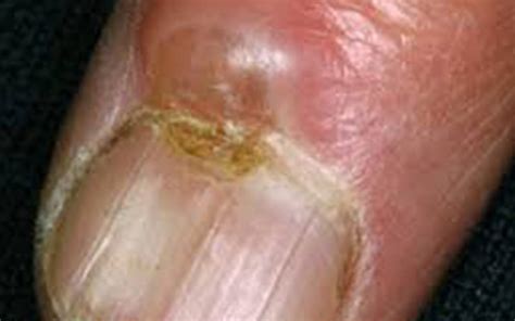 What Are Digital Mucous Cysts Julian Carlo Md