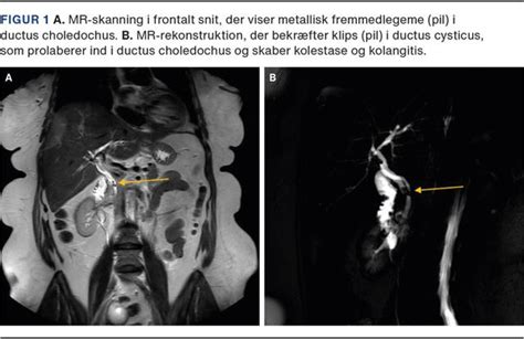 Akut Kolangitis På Grund Af Metalklips I Ductus Choledochus Efter