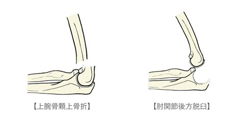 子供に多い腕の骨折：上腕骨顆上骨折の症状や治療について シモウマスポーツ 整骨院 鍼灸院
