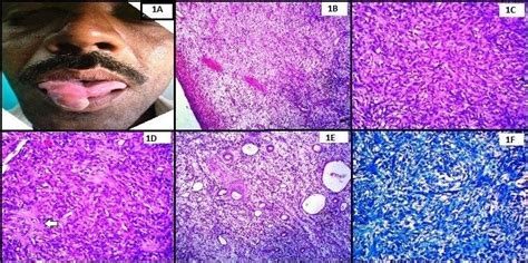 Showing A Solitary Mass Present On Tip Of The Tongue B