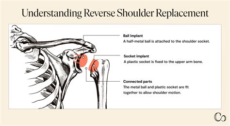 Reverse Shoulder Replacement Surgery 101 In Depth Guide Commons Clinic