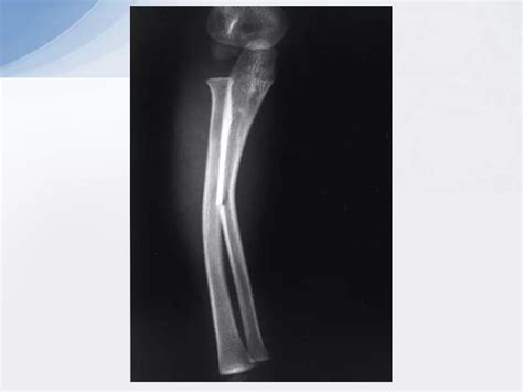 Paediatric Forearm Fractures Pptx
