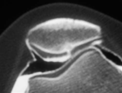 Double Contrast Ct Arthrogram At The Level Of The Lesion Clearly Shows Download Scientific