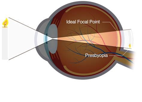 Presbyopia