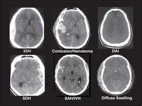 Brody Myopathy Semantic Scholar