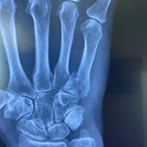 Fractura Base Del 5to Metacarpiano Dr Luis Roberto Rosales Clínica De Ortopedia Y