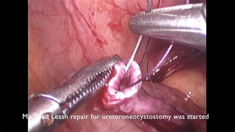 Laparoscopic Ureteroneocystostomy By Muhammad Armughan Youtube