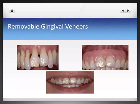 ROOT COVERAGE PROCEDURES PPTX