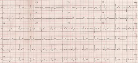Lown Ganong Levine Lgl Syndrome Ecg