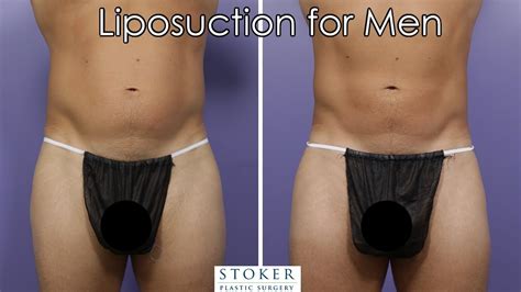 Power Assisted Liposuction For Men In Los Angeles 360 Degree