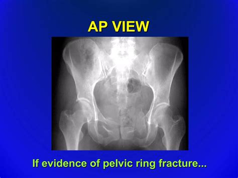 Trauma Pelvic Fracture Ortho Prespective Ppt