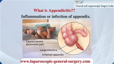 Appendix Removal Surgery In Bangalore Laparoscopic Appendicitis Surgery In India Pdf