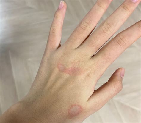 따가운 기름화상 지식in