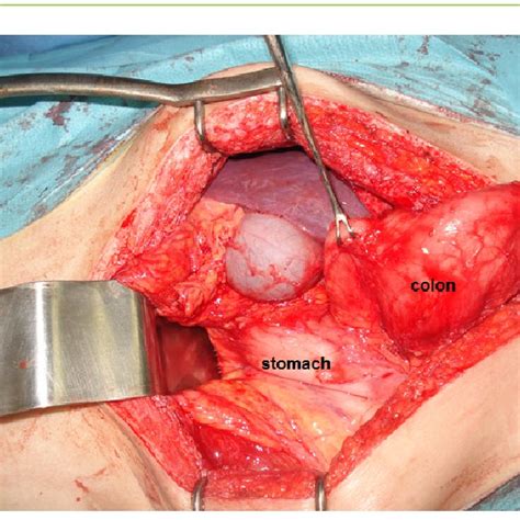 Abdominal And Substernal Redundant Colon Graft Download Scientific Diagram