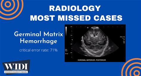 Germinal Matrix Hemorrhage Fetal Germinal Matrix And Intraventricular