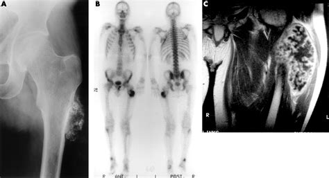 Intermediate Grade Osteosarcoma And Chondrosarcoma Arising In An
