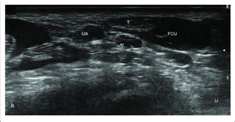Ulnar Nerve At Distal Wrist Crease Ua Ulnar Artery Fcu Flexor