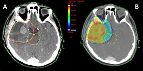 Brain Tumor Radiation Therapy