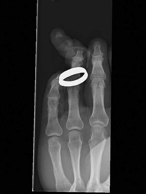 Ring Avulsion Facts Understanding Ring Avulsion Injuries Symptoms