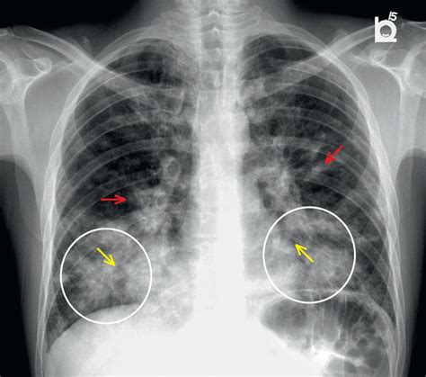 Reticulum Cell Sarcoma X Ray