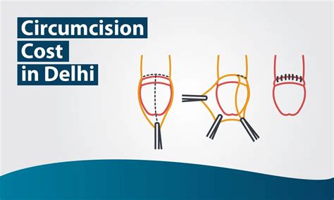 Circumcision Cost In Delhi Find Best Price Apollo Spectra