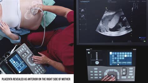 Ultrasound Training For Obstetric Outreach Life Saving Skills Wherever You Are Portable