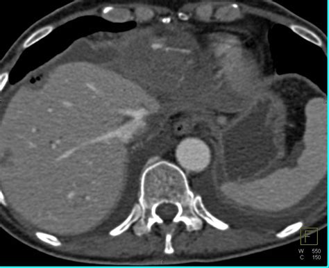 Active Bleed From Vessel In Left Lobe Of The Liver Liver Case Studies
