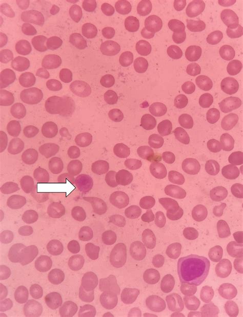 Pdf Rare Mpig6b Gene Mutation In An Indian Male With Anemia And