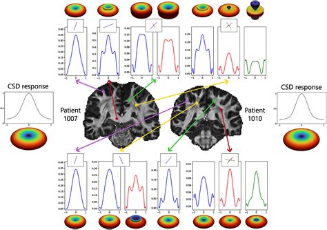 Frontiers Sparse Blind Spherical Deconvolution Of Diffusion Weighted Mri