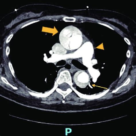 Computed Tomography Ct Angiogram Showing Aortic Dissection In The Download Scientific Diagram