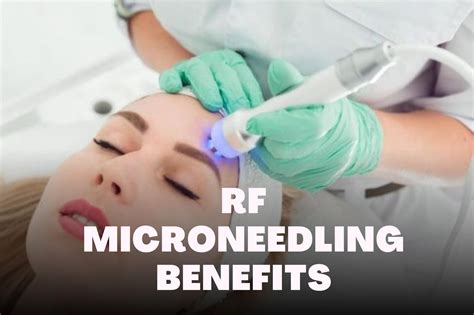 Rf Microneedling Benefits Fitness Beauty Art