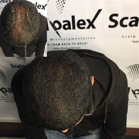 Added Thickness To A Scalpalex Scalp Micropigmentation Added Thickness To A Scalpalex Scalp Micropigmentation