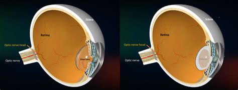 Glaucoma Information Is Glaucoma Associated With Cataract Glaucoma