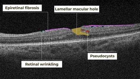 Oct Scan Normal Eye Vs 8 Most Common Pathologies