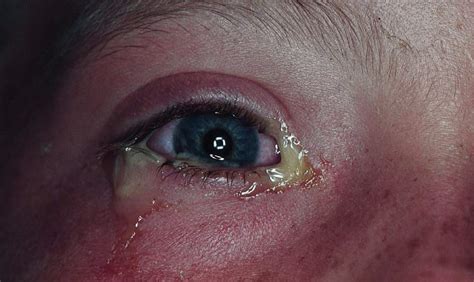 Bacterial Conjunctivitis