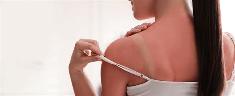 What Is Sunburn And What Symptoms Can Occur Eucerin