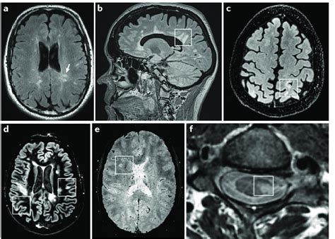 Multiple Sclerosis Mri