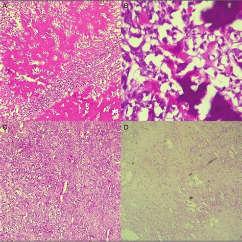 Defect In The Sigmoid Mesocolon And Intersigmoid Recess Download