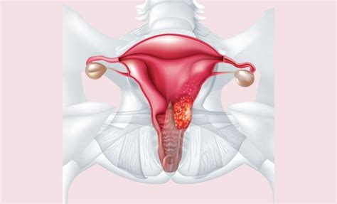 In Focus Polycystic Ovary Syndrome Medical Independent